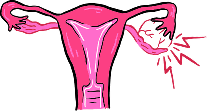 PCOS Symptoms Quiz | Do I Have PCOS Quiz | UK Meds