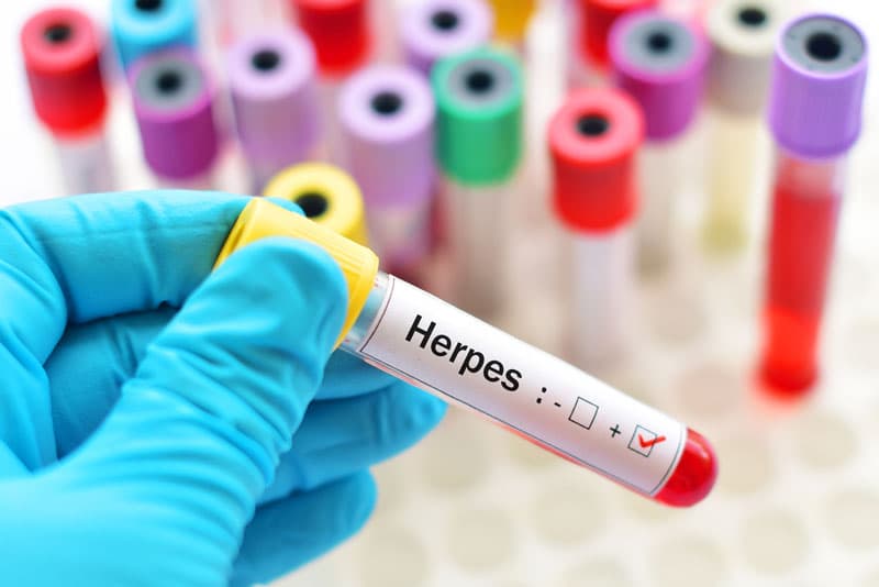 Can Genital Herpes Be Cured? | UK Meds