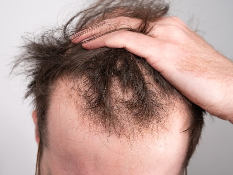 Why Do I Have A Receding Hairline? | UK Meds
