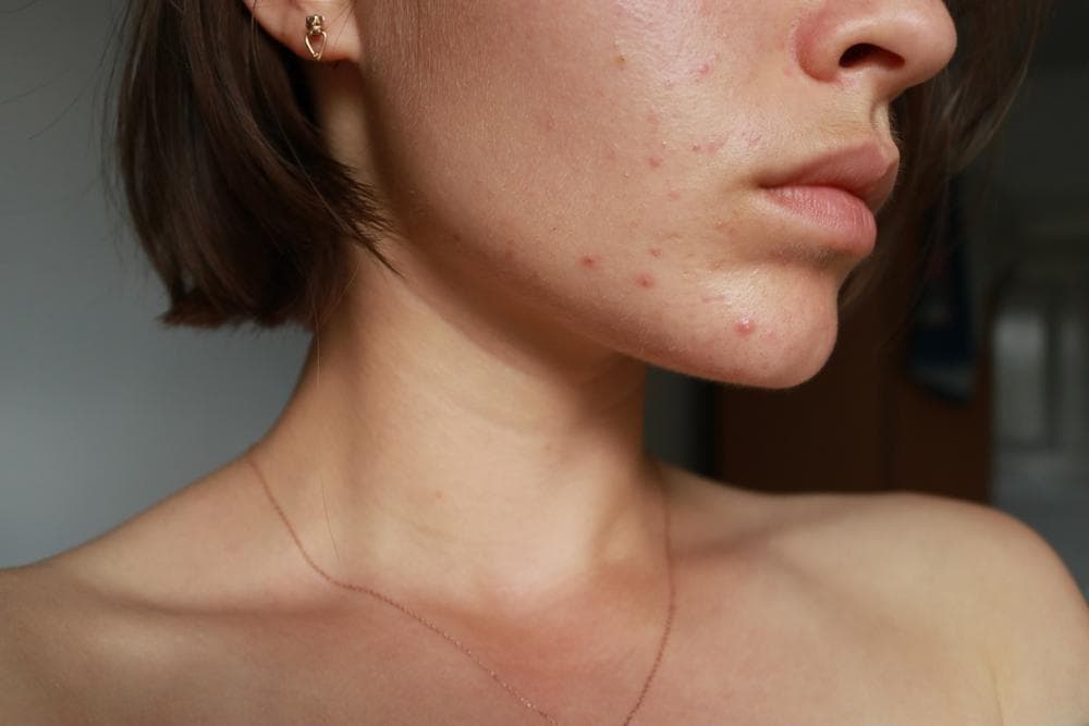 Acne Treatments Comparison: Tretinoin, Treclin Gel & Ketrel