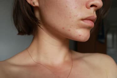 A Beginners Guide to Aknemycin Plus for Acne | UK Meds